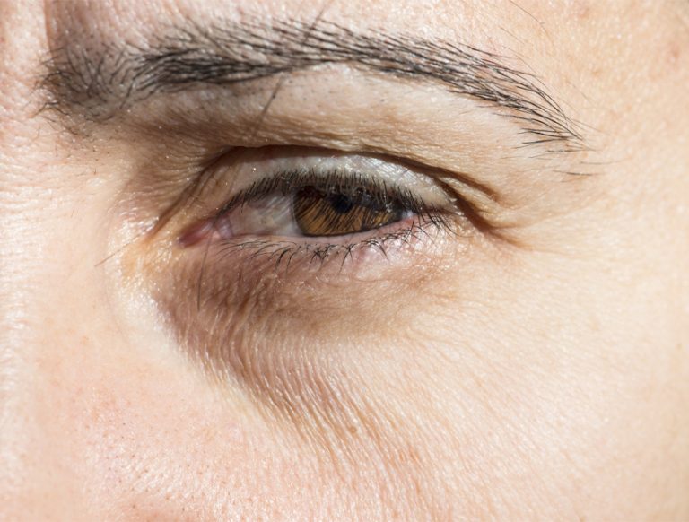 Causes Of Wrinkles Under Eyes: Our 2023 Guide To Prevent Them